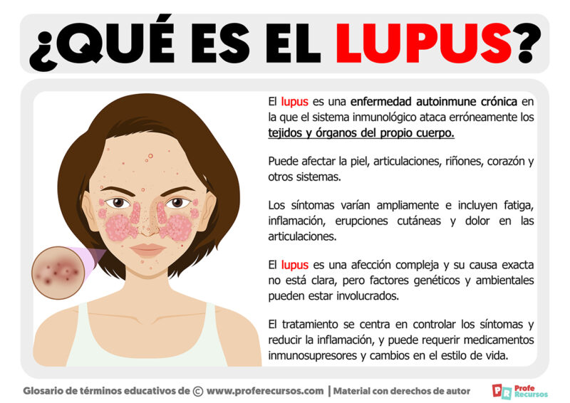 Qué Es El Lupus Definición De Lupus