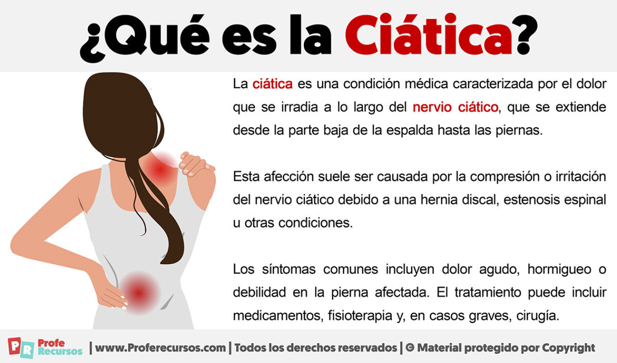 Qué es la Ciática | Definición de Ciática