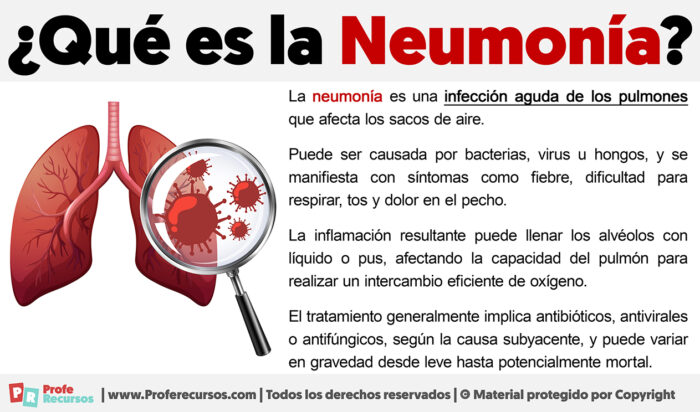 Qué es la Neumonía | Definición de Neumonía