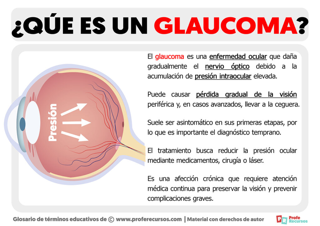 Qué es un Glaucoma | Definición de Glaucoma