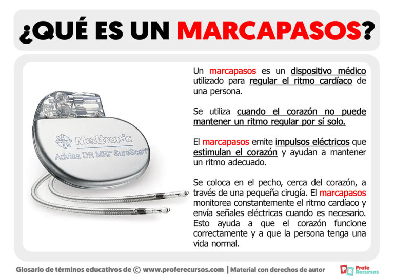 Qué es un Marcapasos | Definición de Marcapasos