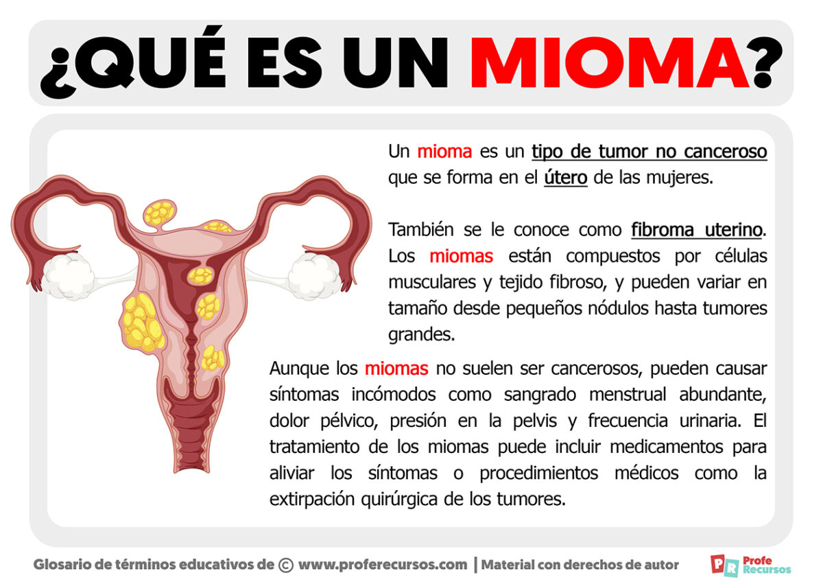 Qué es un Mioma | Definición de Mioma
