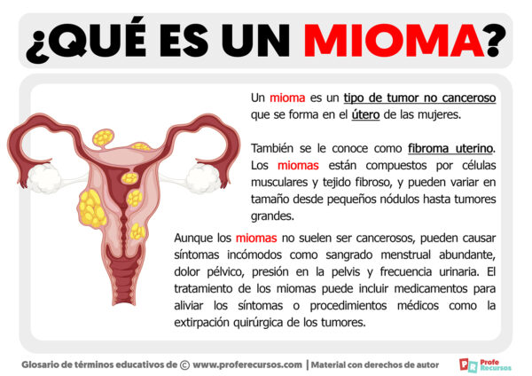 Qué es un Mioma | Definición de Mioma