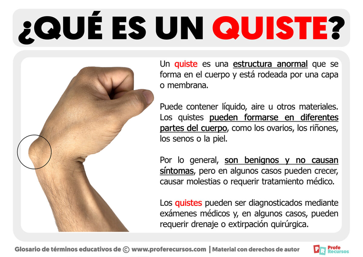 Qué es un Quiste | Definición de Quiste