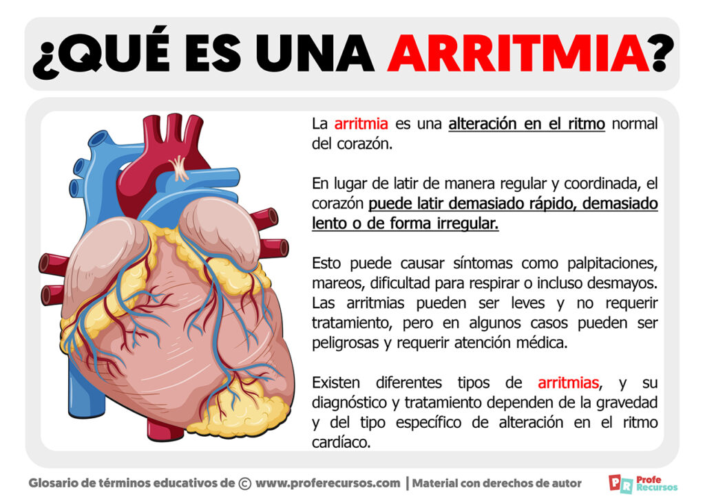 Qué es una Arritmia | Definición de Arritmia