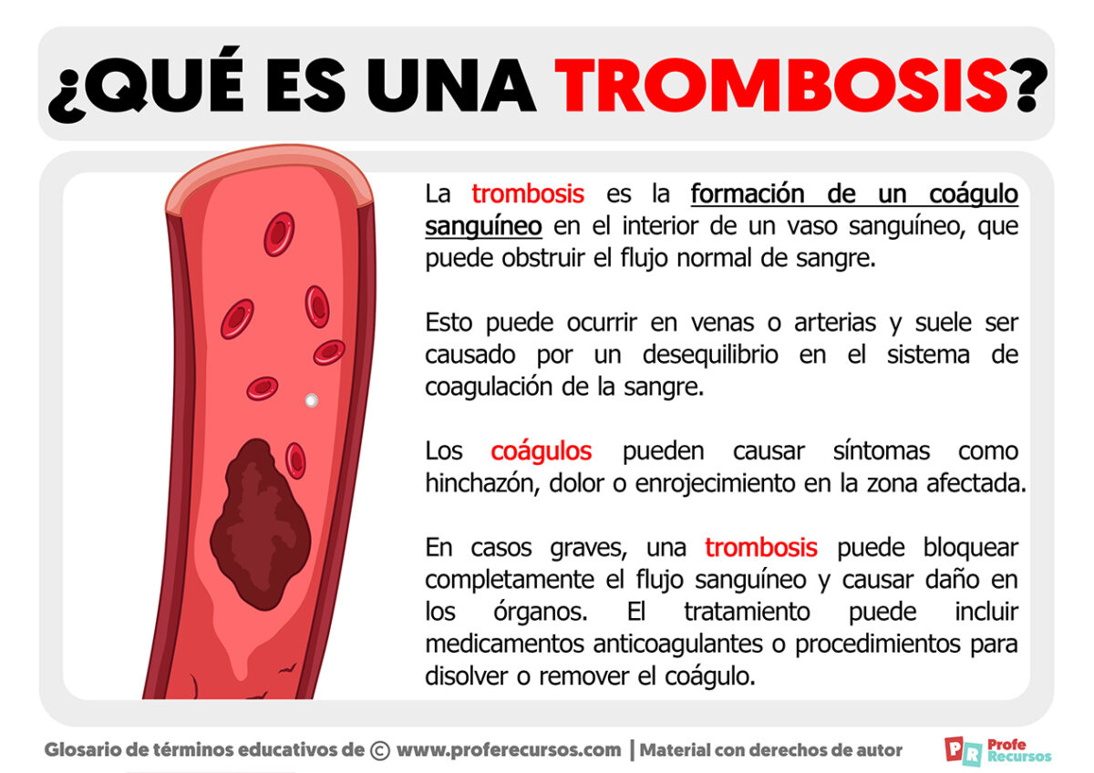 Qué es una Trombosis | Definición de Trombosis